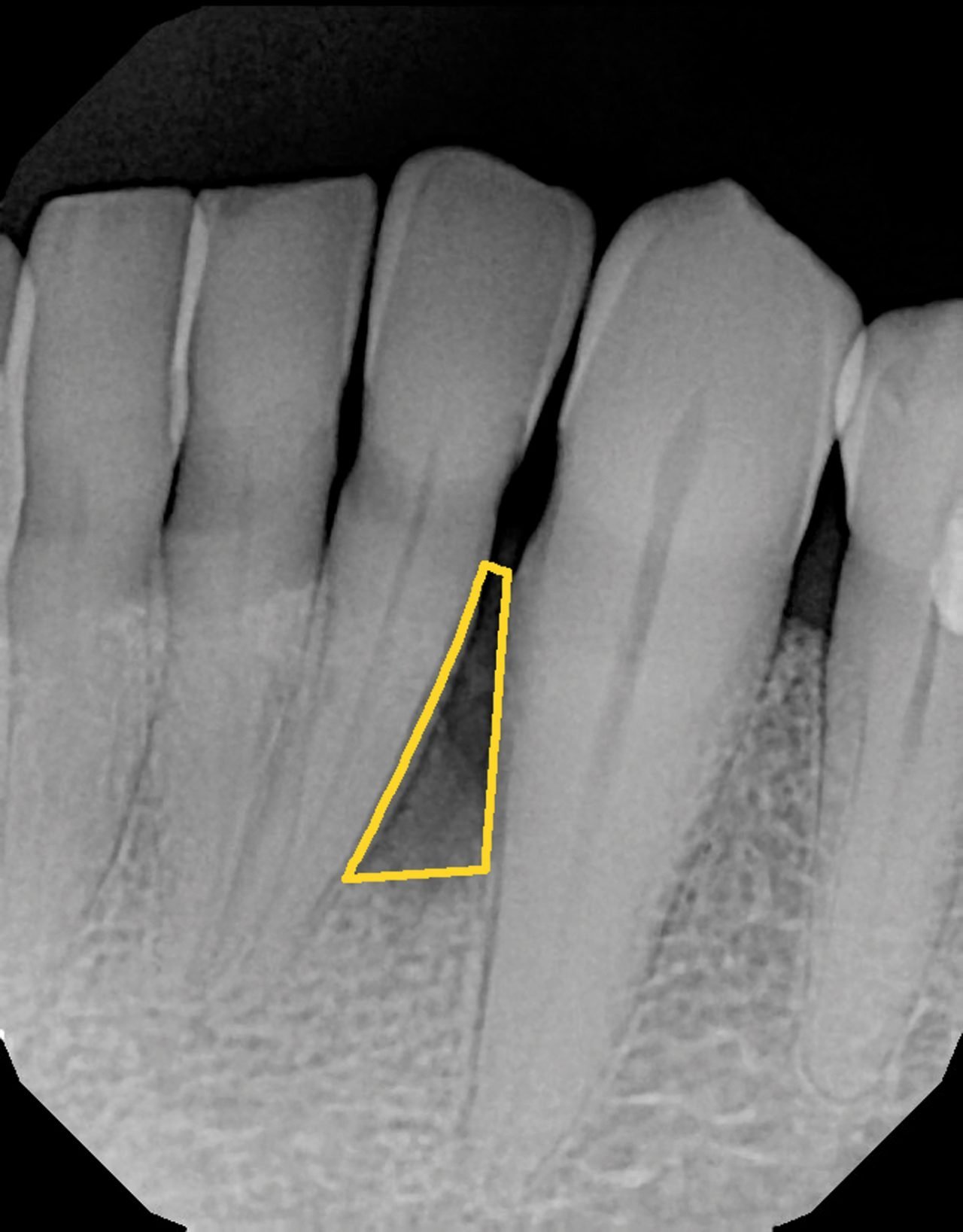 Periodontal Disease Bone Regeneration Barry Heaton DDS